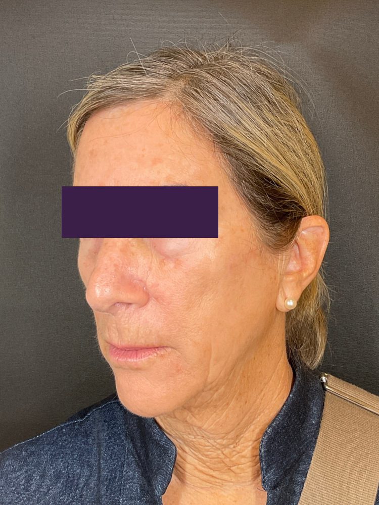 BBL /IPL Before and After Photo Gallery | Sarasota Facial Aesthetics ...